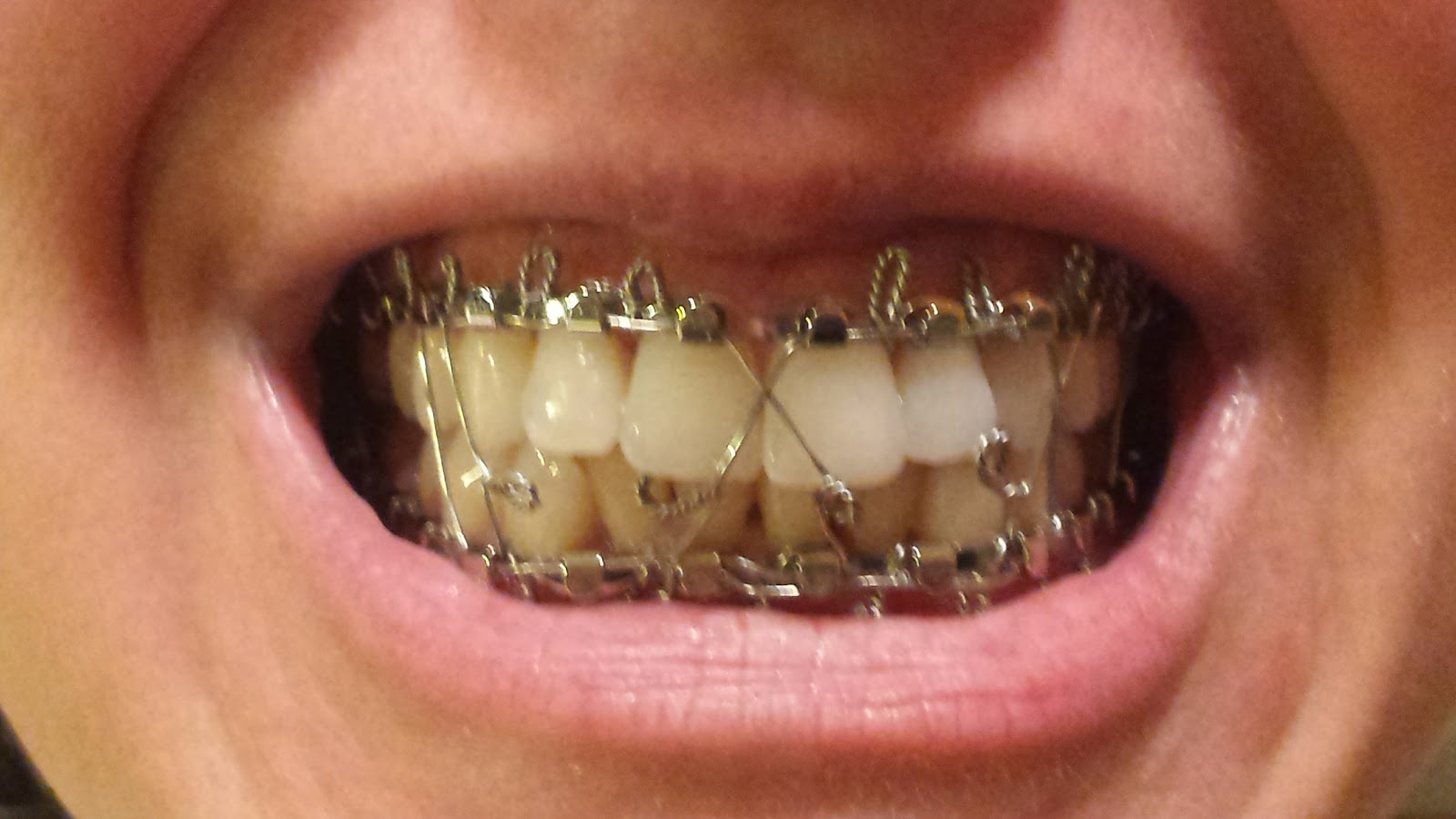 Cheyney and Ryan's Blog: Intraoral vertical ramus osteotomy