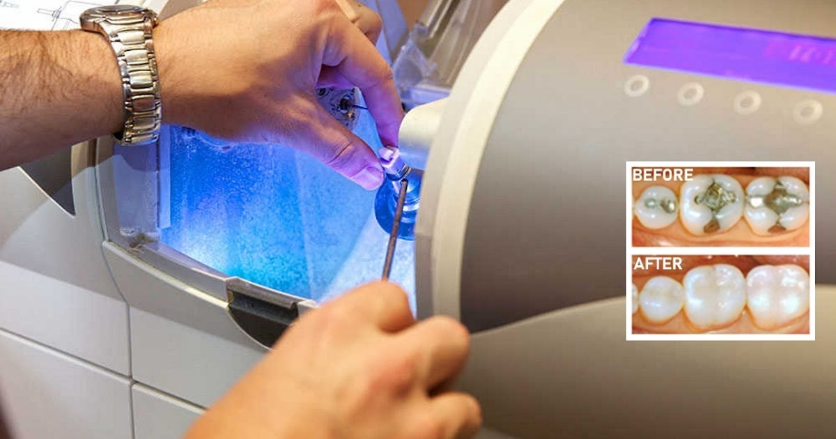 What Are CEREC One-Day Crowns?