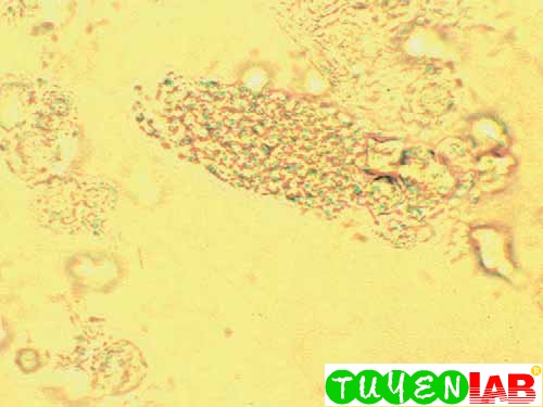 Atlas of Casts in urine | Free Medical Atlas