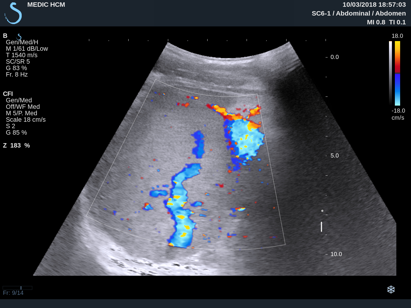 VIETNAMESE MEDIC ULTRASOUND: CASE 484: SPLEEN TUMOR, Dr PHAN THANH HẢI ...