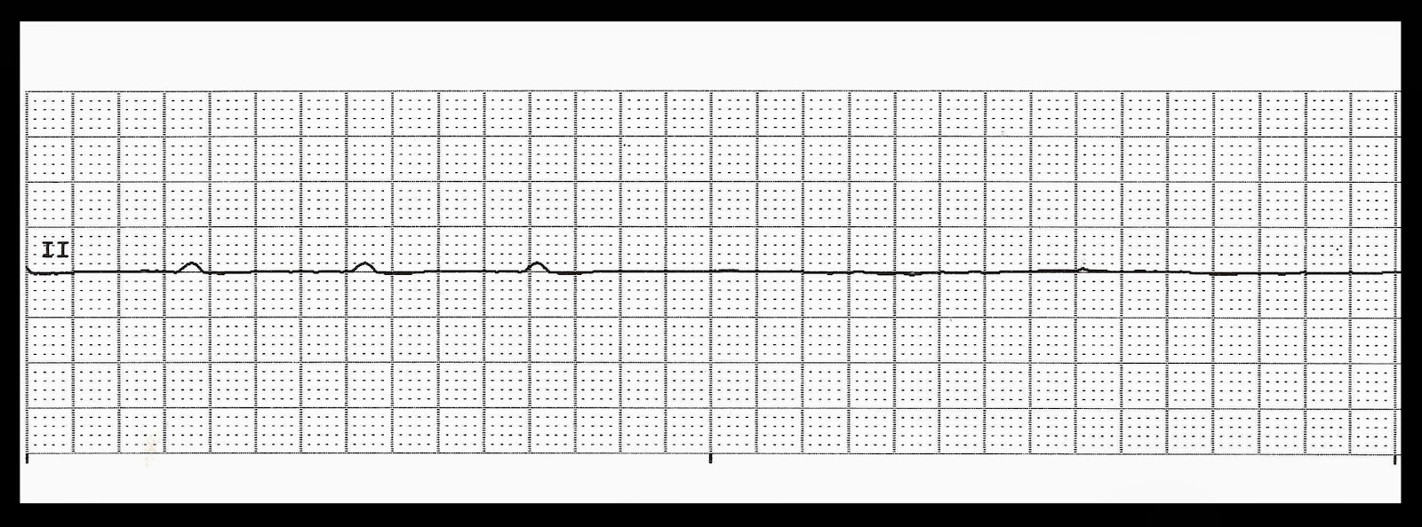 Basic EKG Rhythm Test 15