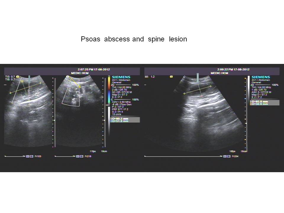 BÀI SOẠN VỀ SIÊU ÂM CHẨN ĐOÁN: PHÂN BIỆT ÁPXE và VIÊM MÔ TẾ BÀO - ÁPXE LẠNH