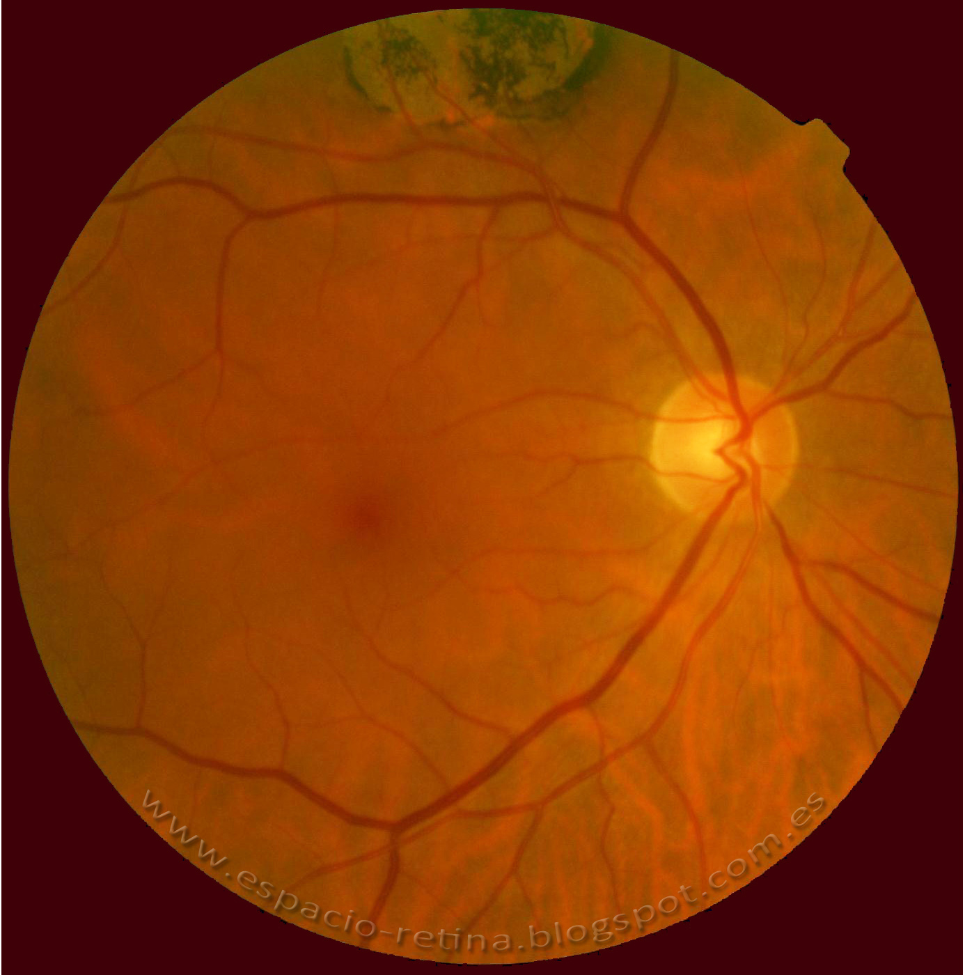 ESPACIO RETINA: Cicatriz postcoriorretinitis.