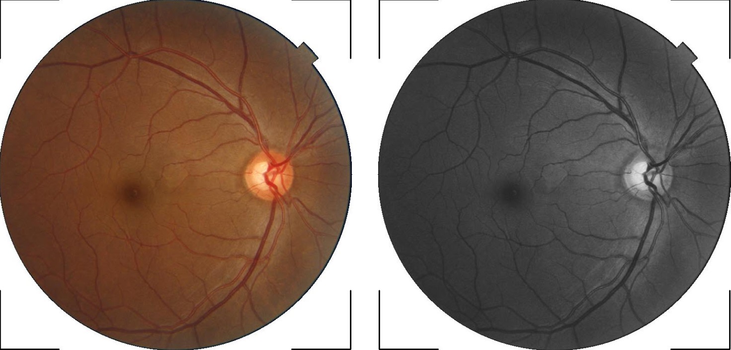 Jiri Eye Study: Macular hole