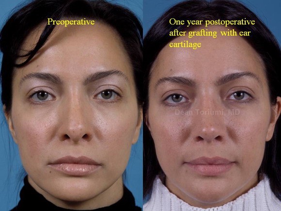 Dr. Dean Toriumi Reviews: Secondary Rhinoplasty surgeries: 2