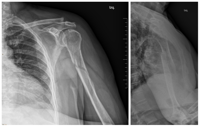 El Blog de Isa y Juan: Fractura de la diáfisis del húmero