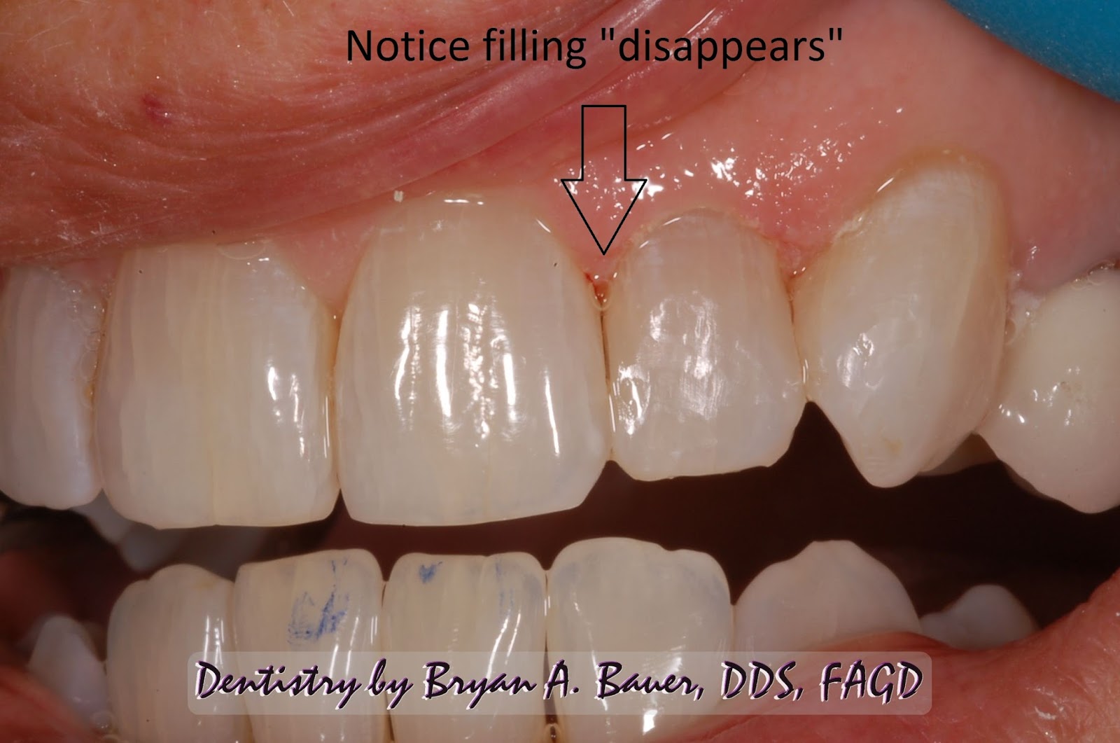 Old brown filling - Bauer Smiles