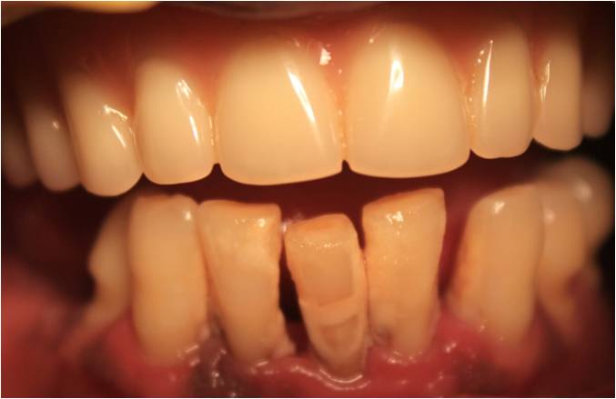 Basal dental implants cost: UPPER AND LOWER FULL ARCH RESTORATION WITH ...