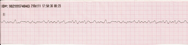 EKG Rhythm Strip Quiz 24