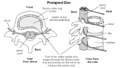 What causes a prolapsed disc or slip disc?