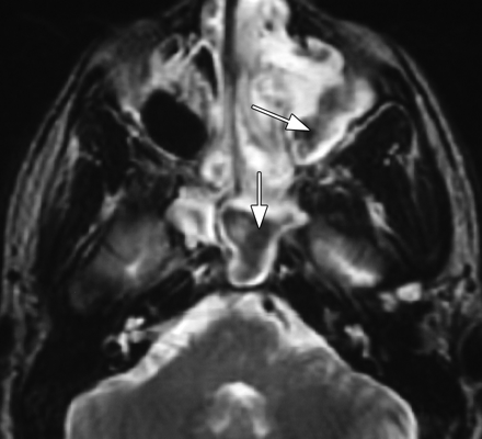 Radiologist For Ever: Paranasal sinuses rule 3 :Causes of sinus ...