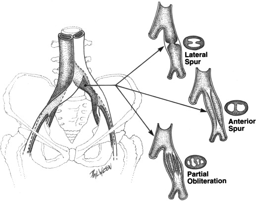 The Pump and the Tubes: May-Thurner Syndrome