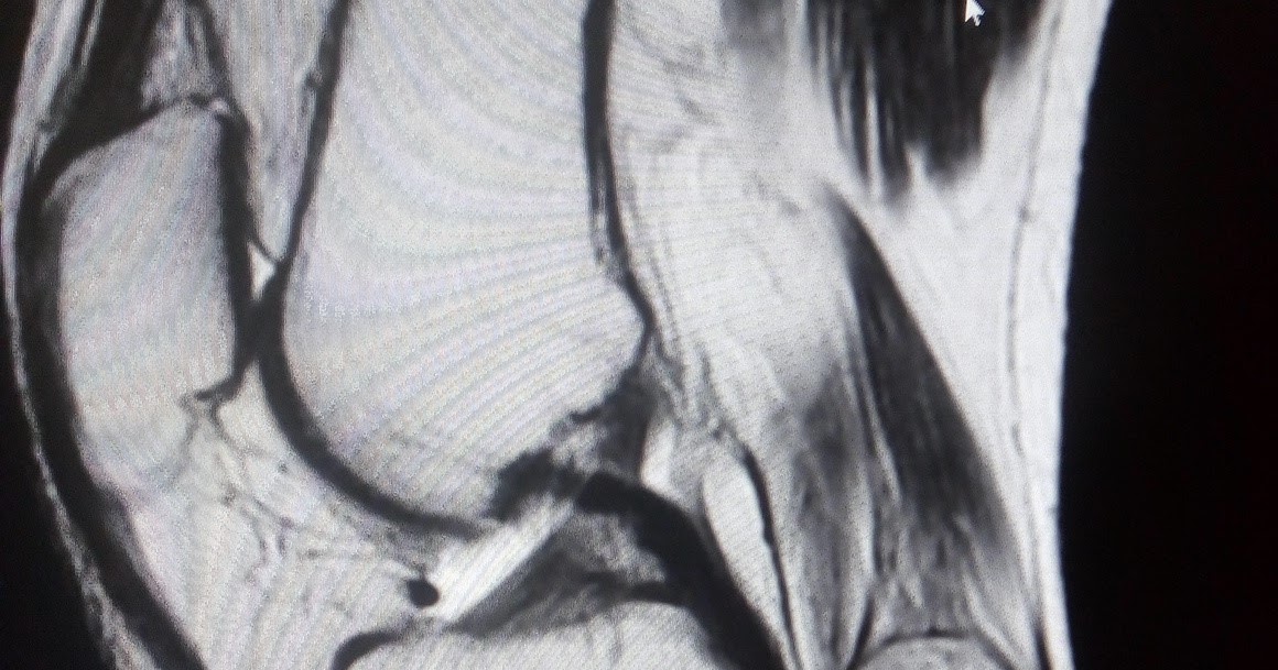 Neurogenic tumor: Teaching Points - Sumer's Radiology Blog