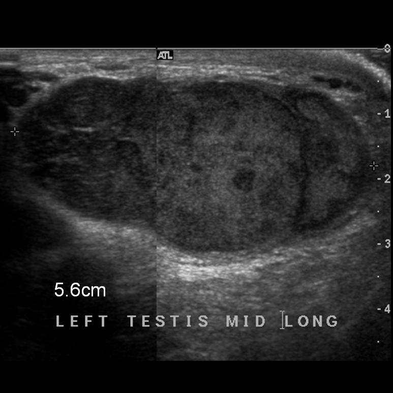 Testicular Cancer Ultrasound Testicular Cancer And Male Infertility