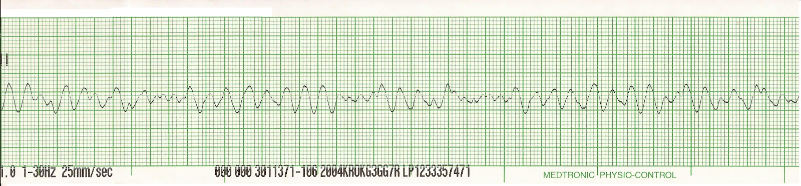 Float Nurse: Pulseless VF/VT