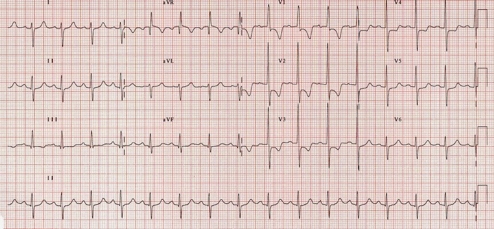 pulmonary disease pattern ecg Hình ảnh có liên quan - Diseases Club ...