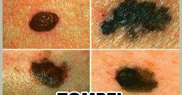 Cara alami menghilangkan tompel hitam di wajah atau leher yg ampuh