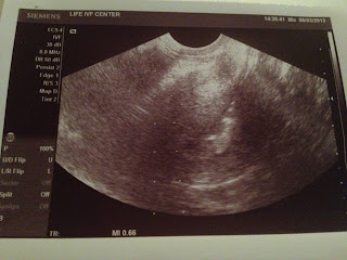 Chasing Baby B: 5 Day TRANSFER of a 5AA Embryo!!!!!!!!!!