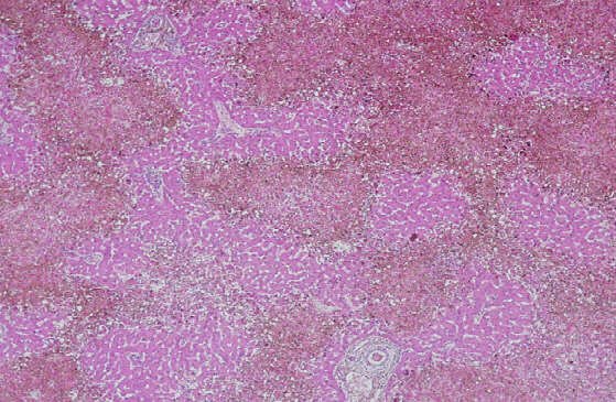 Patologia Basica y Anatomia Patologica: Necrosis Celulares