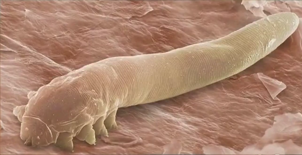 Eyelash Mites Millions Of People Have Them And Don’t Know (Symptoms ...