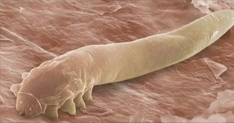 Eyelash Mites Millions Of People Have Them And Don’t Know (Symptoms ...