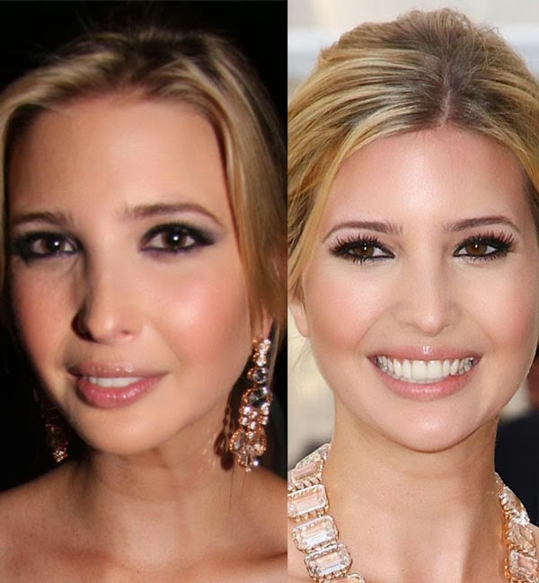 Ivanka Trump Plastic Surgery Nose Job, Botox Injections, Breast ...