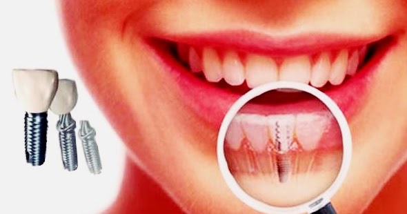 Ketahuilah Mengenai Implan Gigi Sebelum Melakukannya! | Dokter Gigi