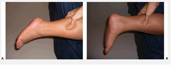 Orthopaedi dan Traumatologi: CIDERA TENDON ACHILLES PADA OLAH RAGA