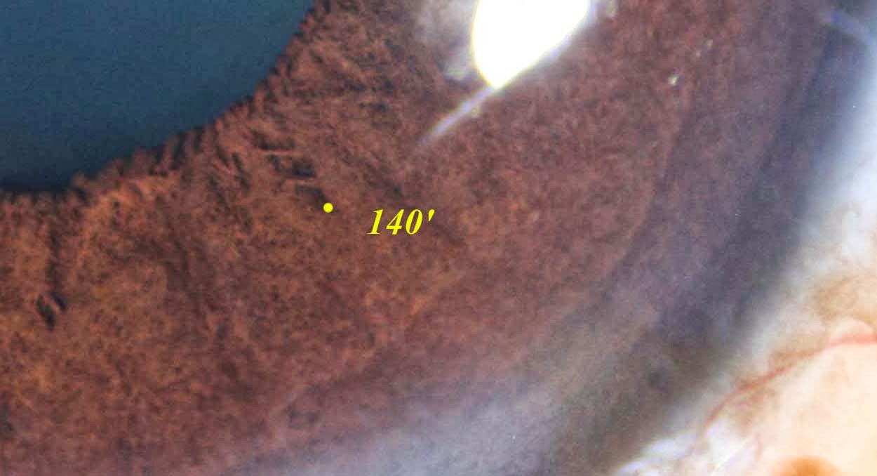 Modern & Multidimensional Iridology: IPB, Collarette Structure ...