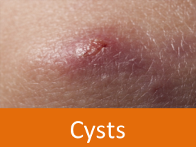 Types of Acne ~ Acne Slayer