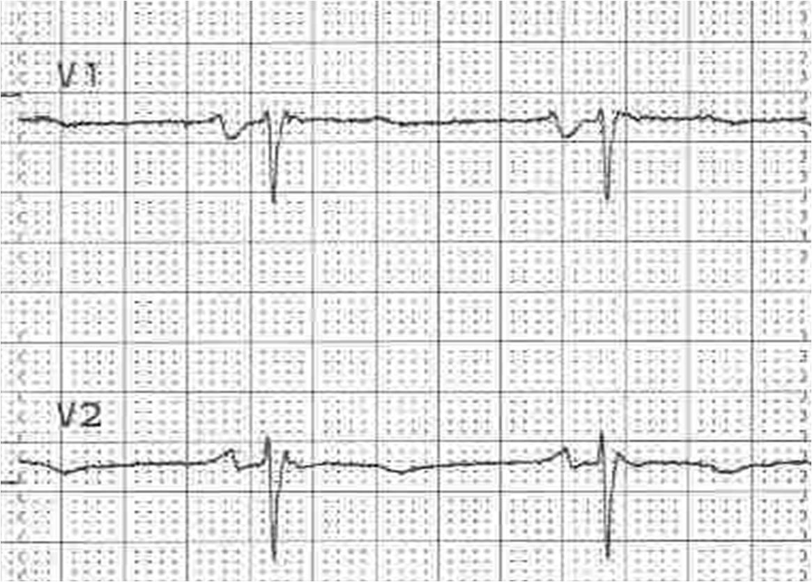 Epsilon+wave+ecg