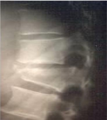 Biomecanica del hueso: Fuerzas a que puede ser sometido un hueso