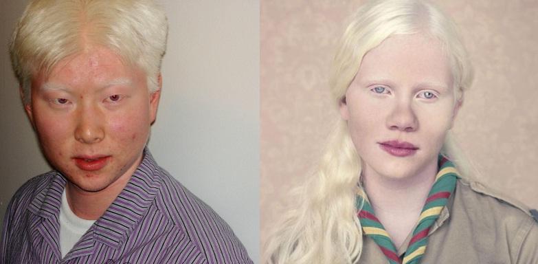 Osobliwości z całego świata-: Albinizm