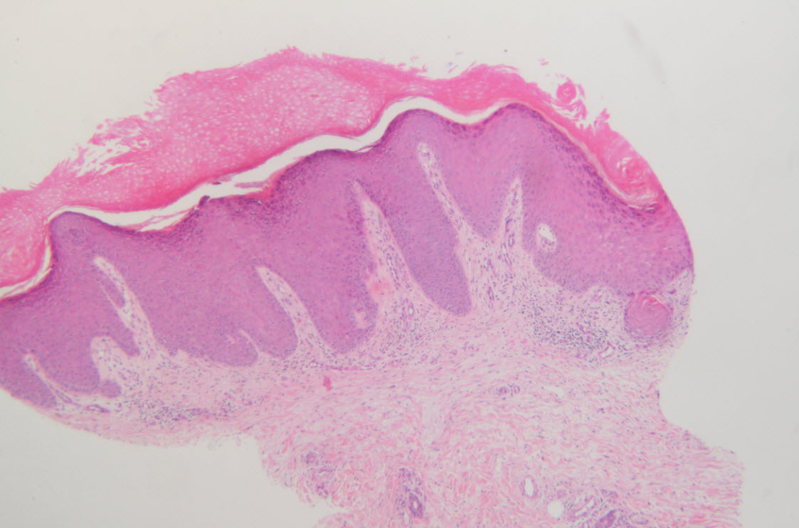 Consultations in Dermatoscopy: Pink and Purple