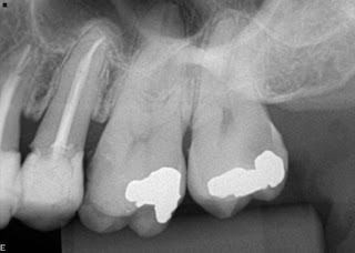 Patrick Baltieri: CASO CLINICO DENTE 26 - EASY PRODESIGN LOGIC