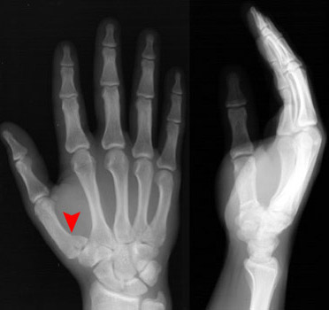Bone Section: intra-articular fracture-dislocation of the base of the ...