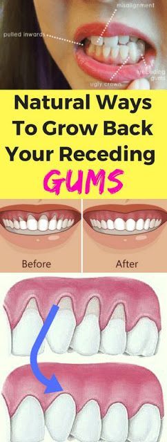 Here Are 3 Natural Ways To Grow Back Your Receding Gums!!! - HEALTH ROOTS