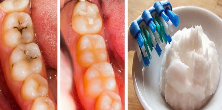 5 Steps For Healing Your Tooth Decay and Reverse Cavities