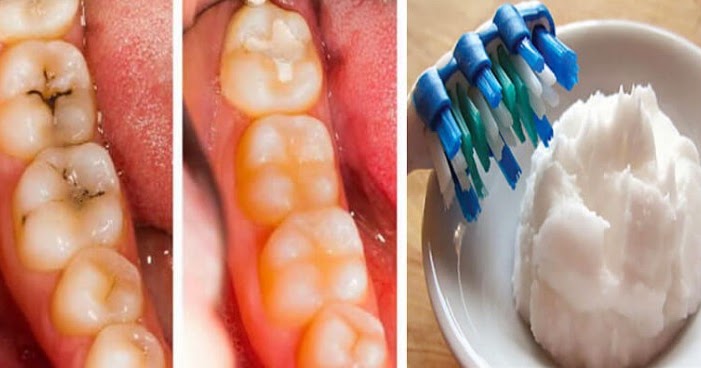 5 Steps For Healing Your Tooth Decay and Reverse Cavities