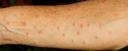 Dein NachbarLohbach: Bade-Dermatitis