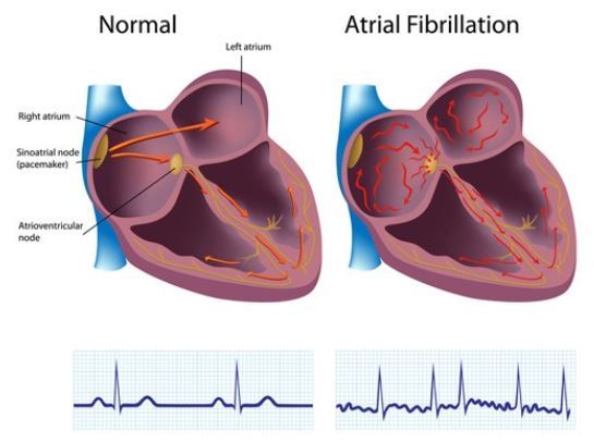 Asuhan Keperawatan Atrial Fibrilasi - Patofisiologi, dan Rencana ...