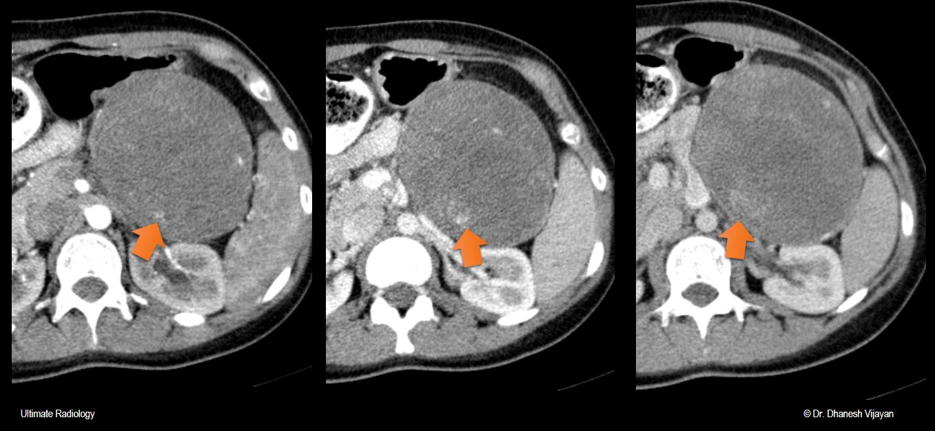 Ultimate Radiology : Solid Pseudopapillary Tumor of Pancreas