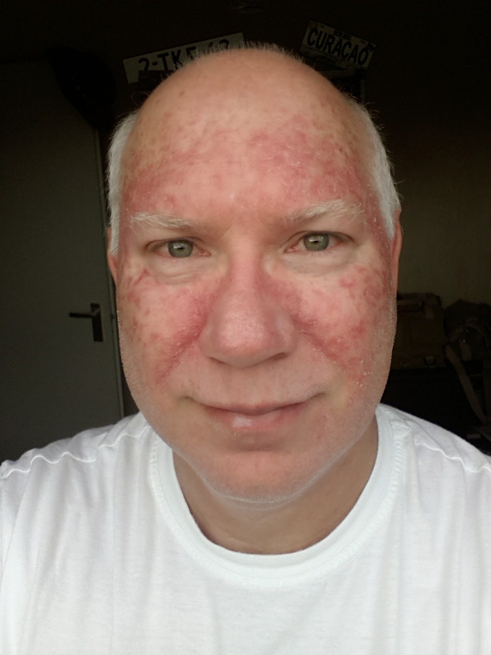 Resultaat gebruik Efudix: Algemeen