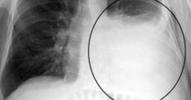 MESTI BACA !!! Apa Sebenarnya Penyakit Paru-paru Berair ini? | Info Santai