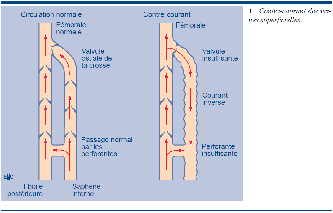 Varices et insuffisance veineuse chronique - Documents de Médecine