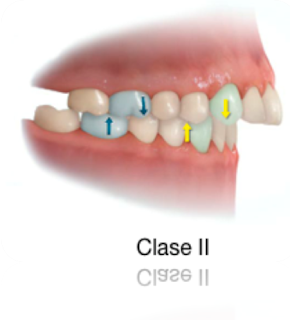 MALOCLUSIONES CLASE II