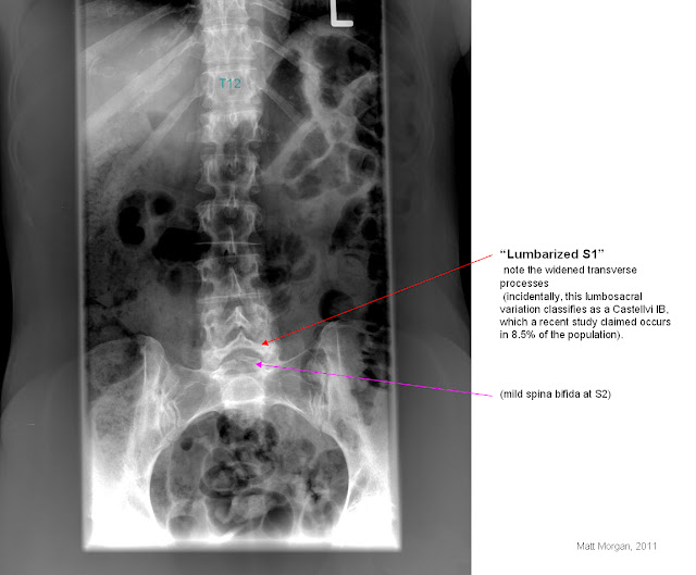 Skull and Spine: Lumbosacral transitional vertebrae