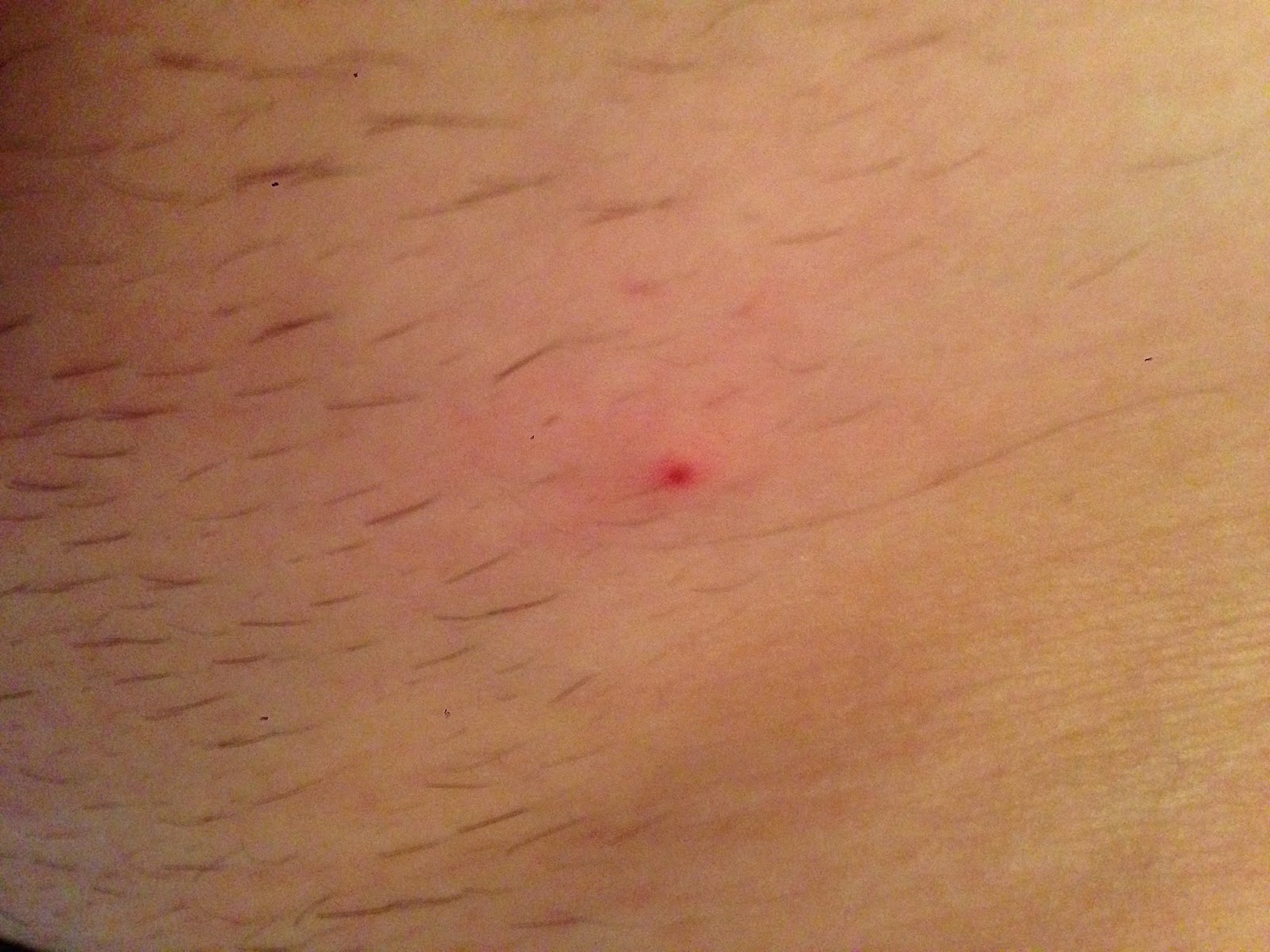 Scabies Treatment That Truly Works (My Personal Experience): Diagnosing ...