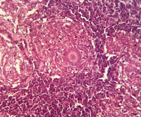 into the roots: Sarcoidosis