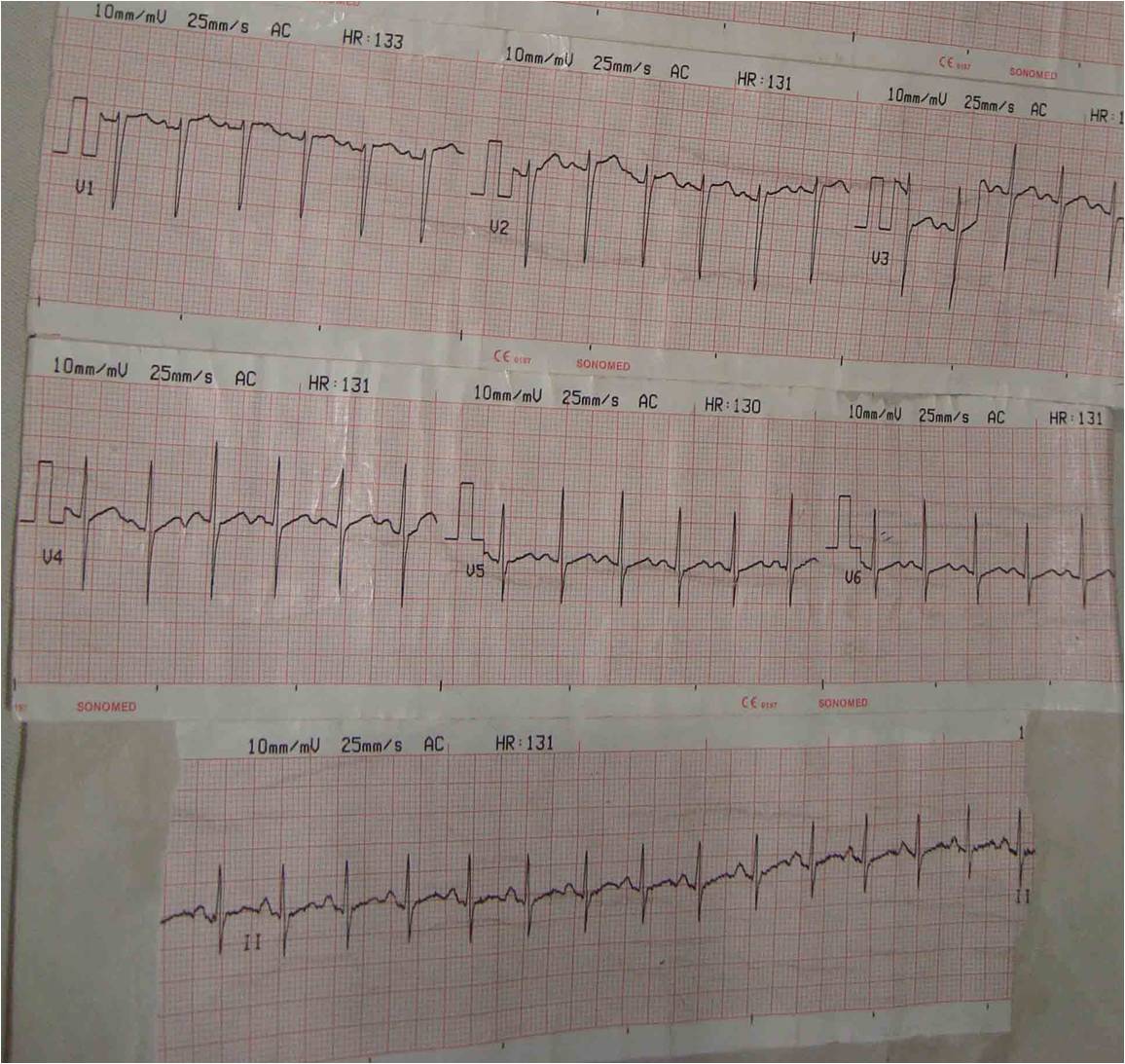 Pulmonary Embolism Patient- Clinical Scenario and Diagnosis-